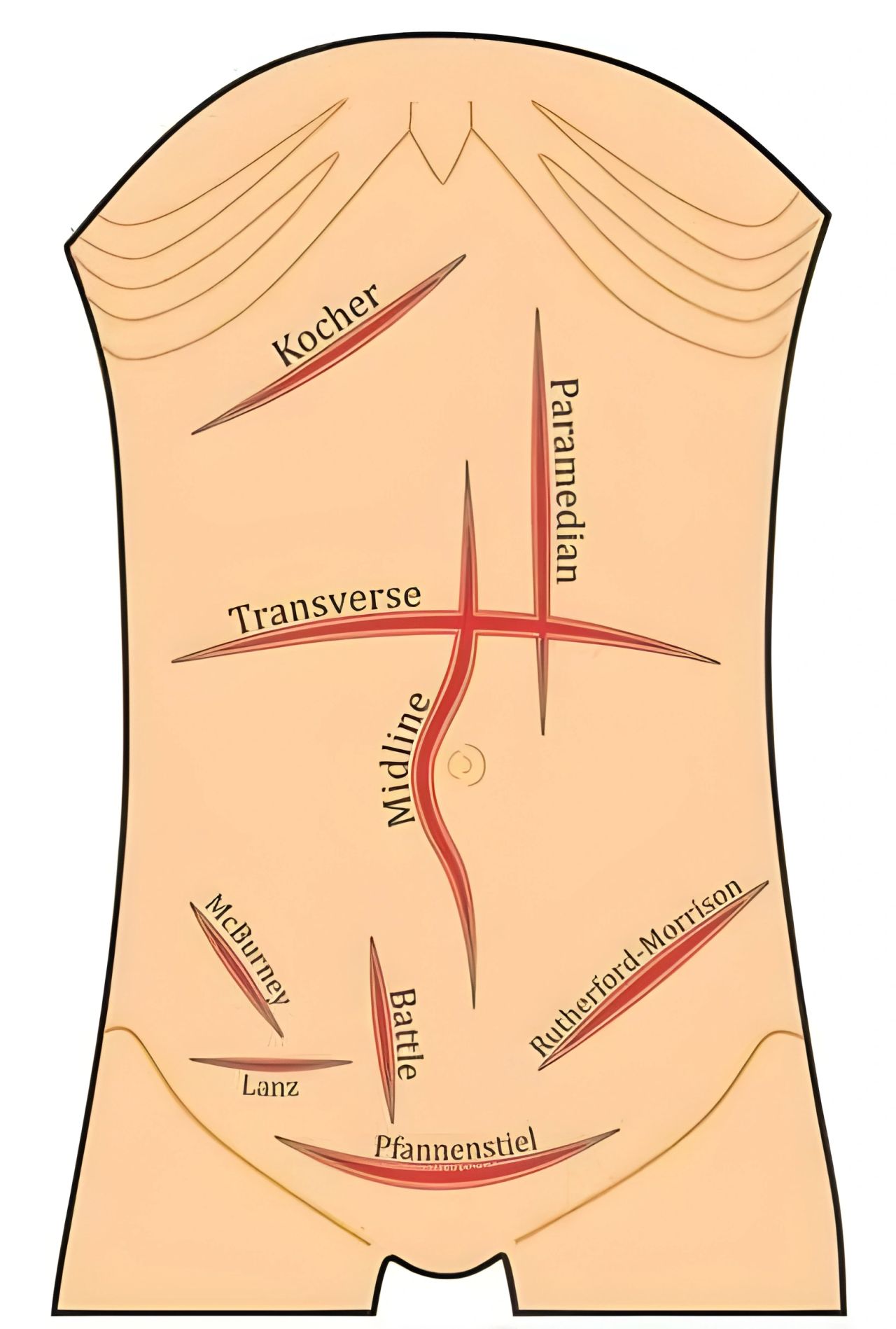 Incisions of Abdominal Surgery - Pharma Digests